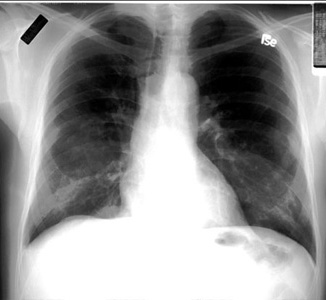 Atelectasis Chest X Ray